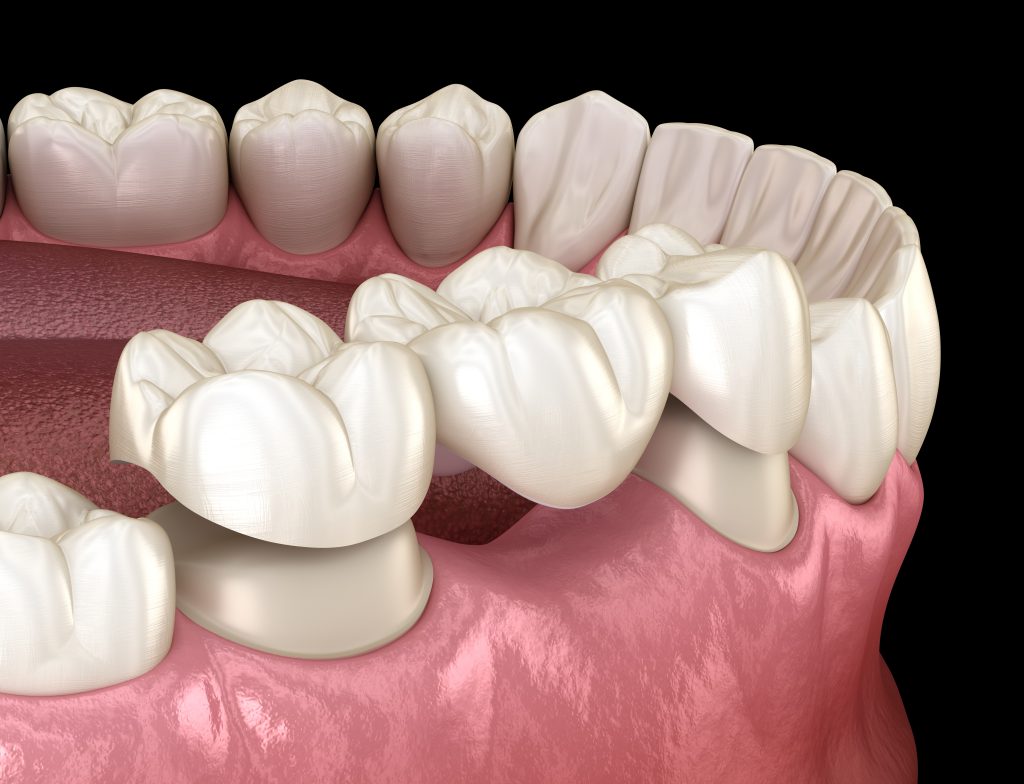 Porcelain Fixed Bridges in Grand Prairie | Great Southwest Family Dental